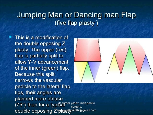 scar revision , z plasty