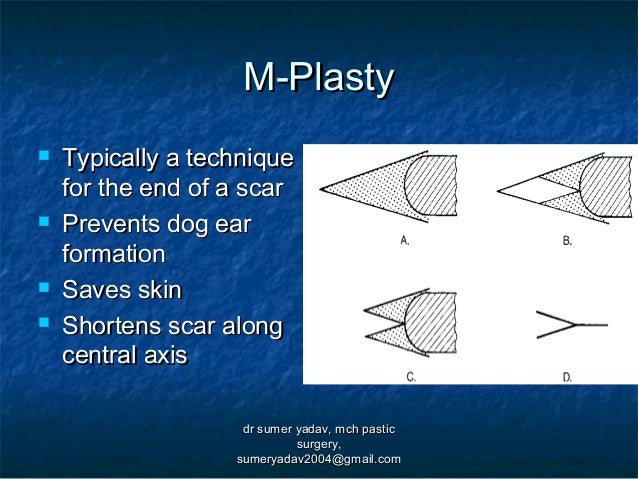 scar revision , z plasty