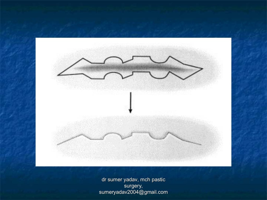 Scar Revision Z Plasty