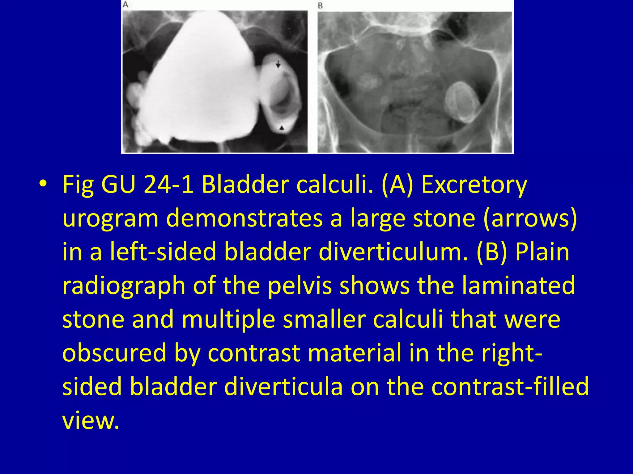 24 single or multiple filling defects in the | PPTX