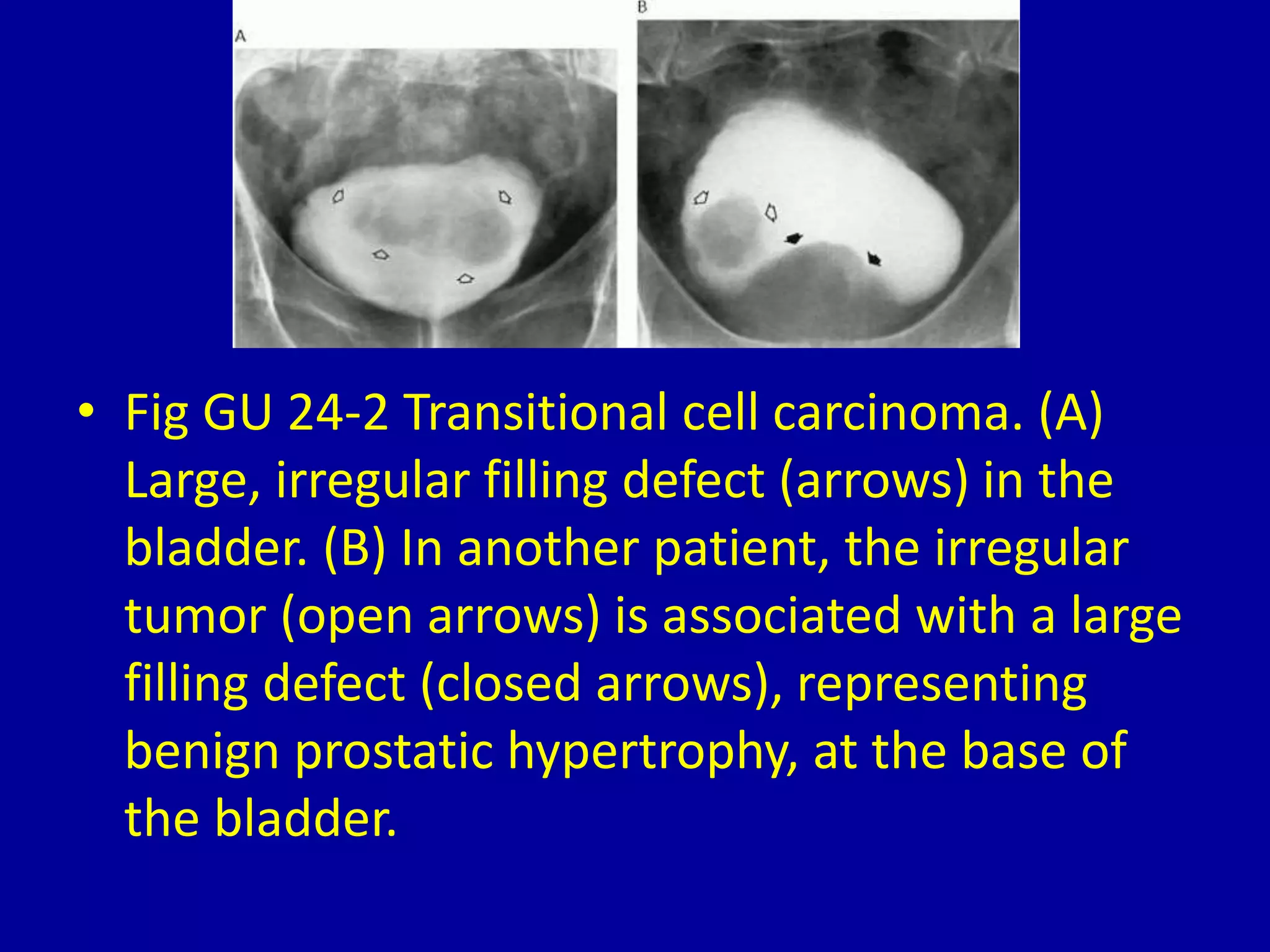 24 single or multiple filling defects in the | PPTX