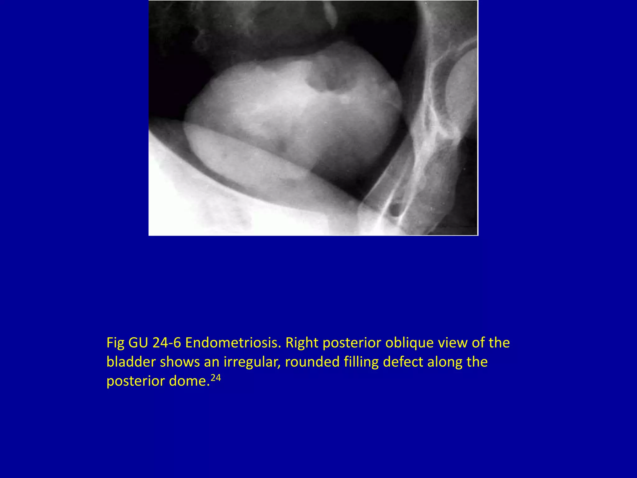 24 single or multiple filling defects in the | PPT