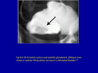 24 single or multiple filling defects in the | PPTX