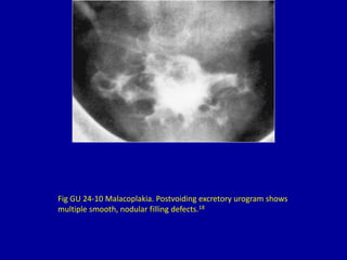 24 single or multiple filling defects in the | PPTX