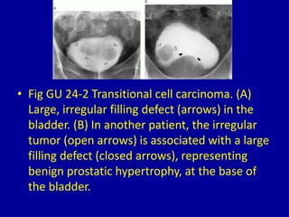 24 single or multiple filling defects in the | PPTX