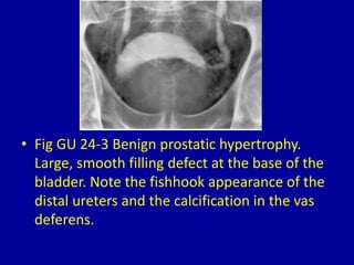 24 single or multiple filling defects in the | PPTX