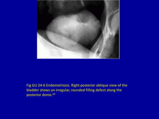 24 single or multiple filling defects in the | PPTX