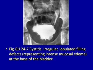 24 single or multiple filling defects in the | PPTX