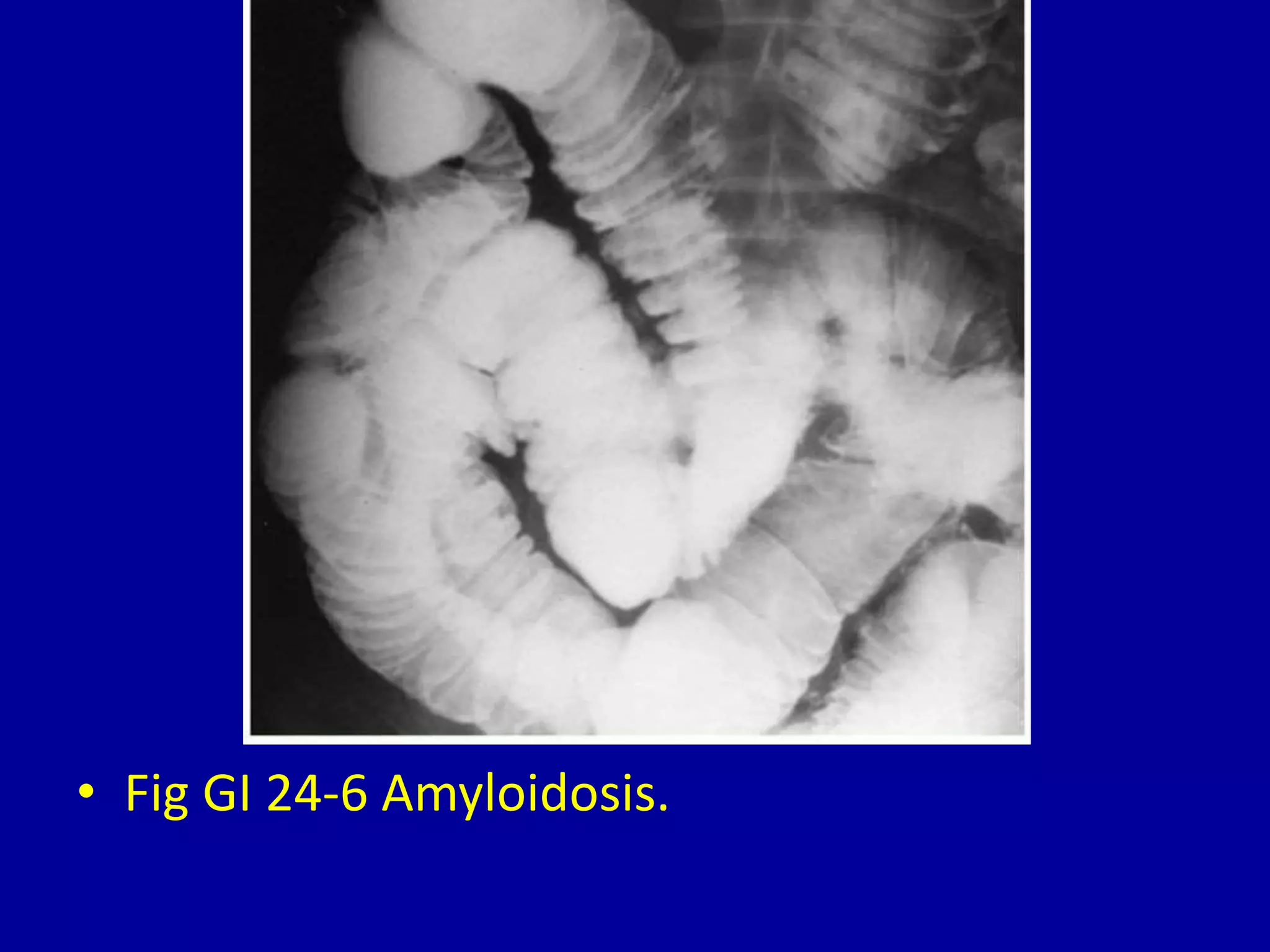 24 small bowel dilatation | PPT