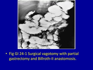 24 small bowel dilatation | PPT
