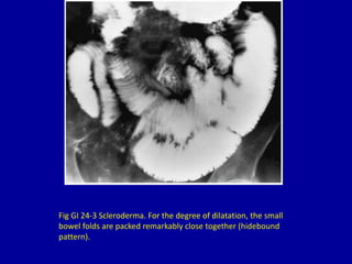 24 small bowel dilatation | PPT