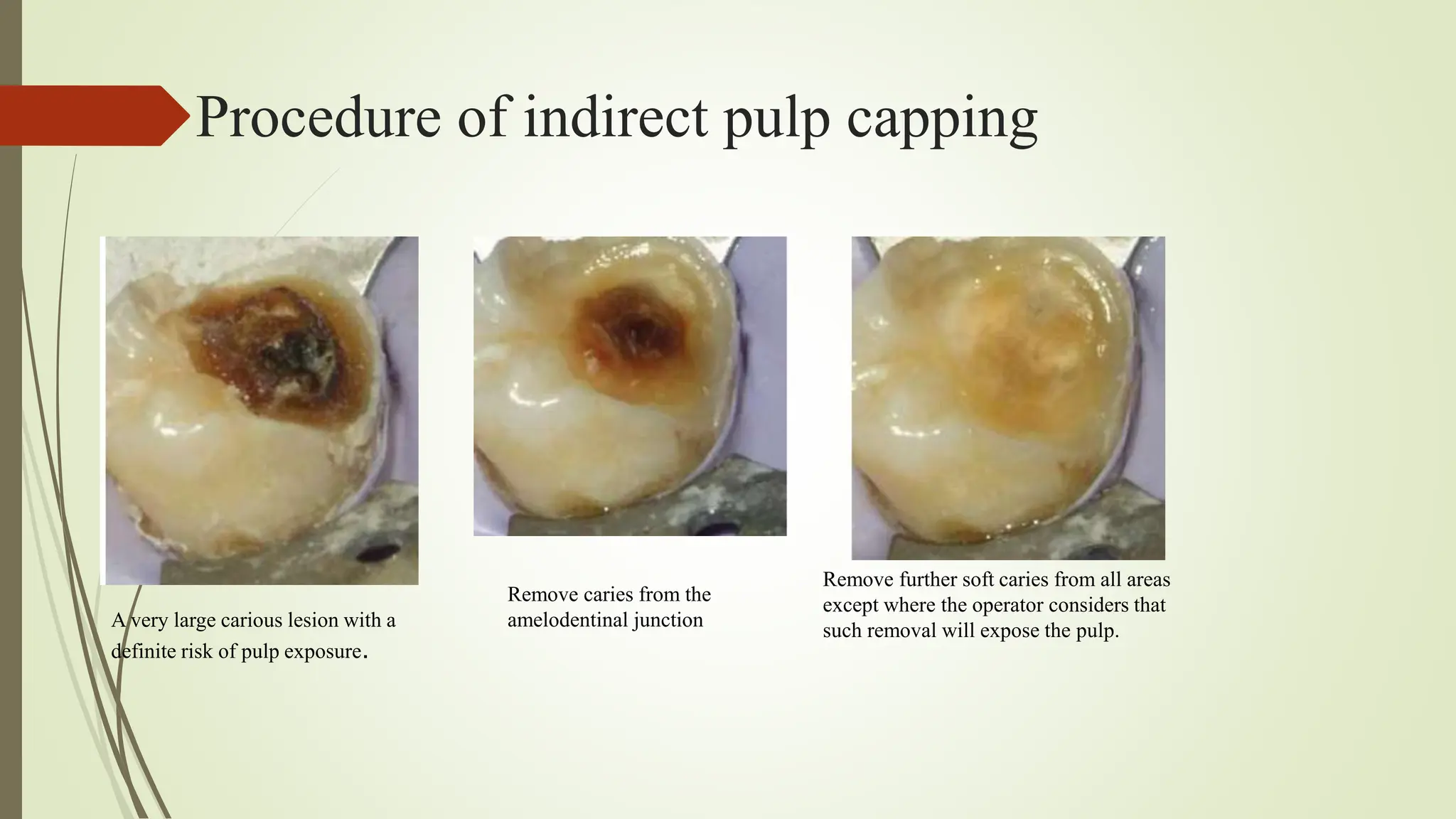 24th oct Pulp Therapy In Young Permanent Teeth.pptx