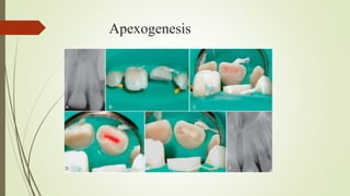 24th oct Pulp Therapy In Young Permanent Teeth.pptx