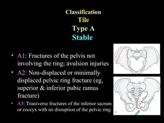 25. management of pelvic ring injuries | PPT