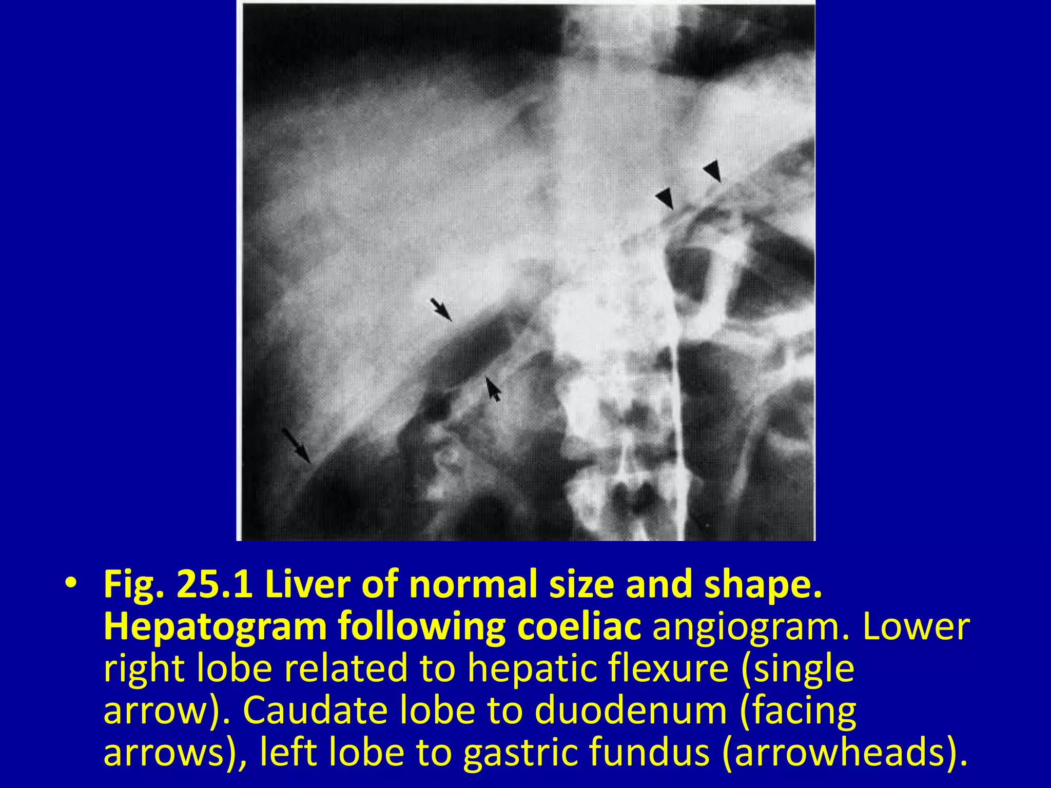 25 DAVID SUTTON FRACTURE THE LIVER AND SPLEEN | PPTX | Digestive ...
