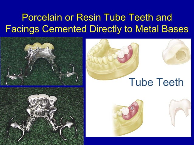 25. rpd denture bases+teeth | PPT | Oral care | Personal Care