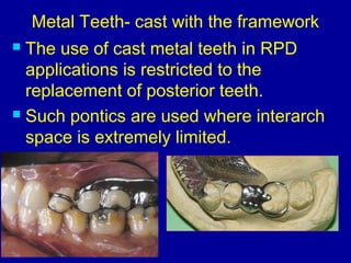 25. rpd denture bases+teeth | PPT