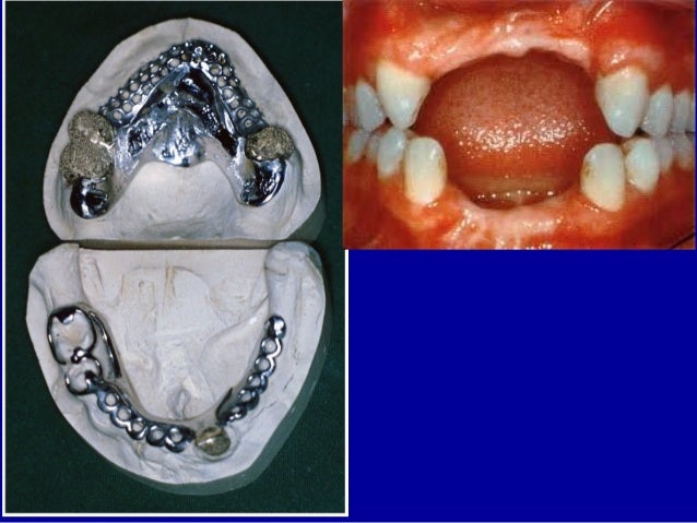 25. rpd denture bases+teeth
