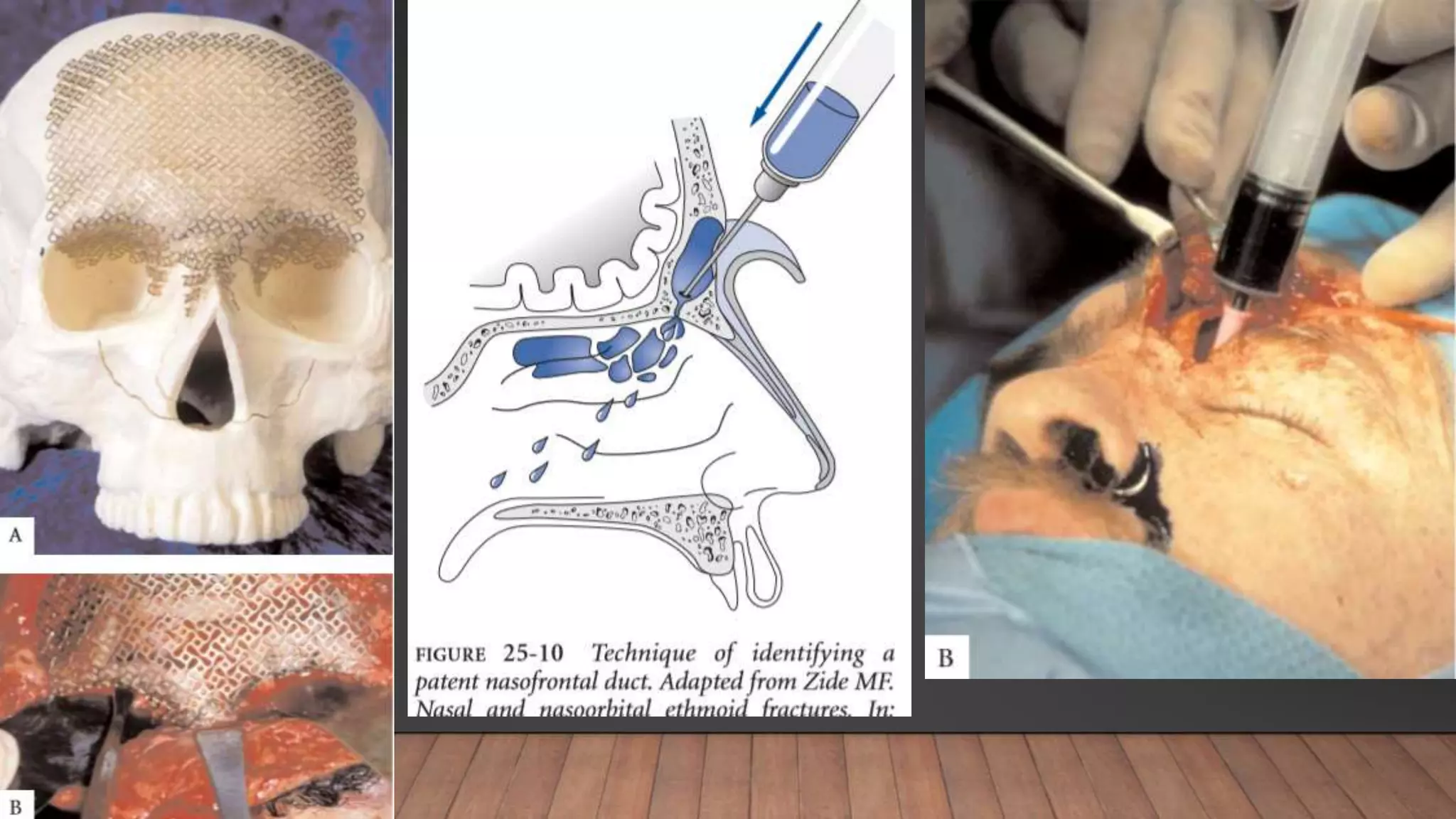 Facial Fractures II | PPT