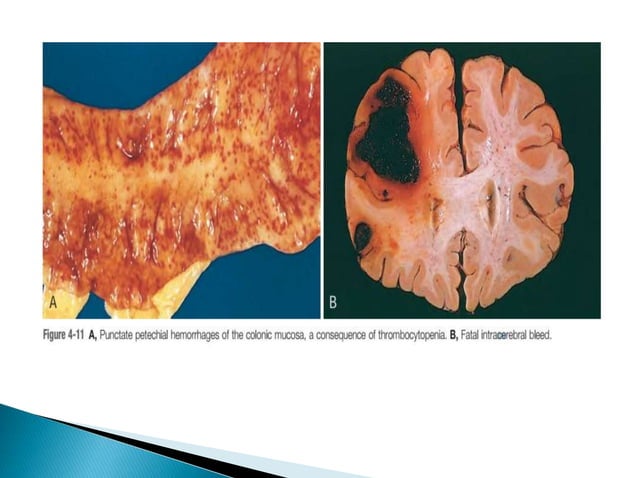 Hemorrhage detailed pathology and route causes of hemorrhage and their ...