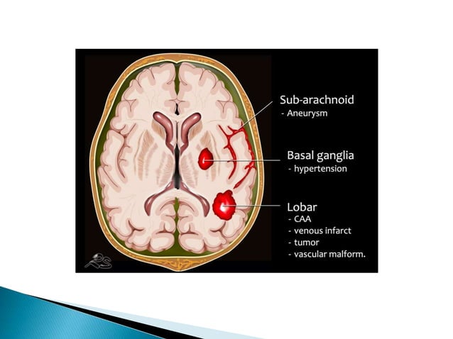 Hemorrhage detailed pathology and route causes of hemorrhage and their ...