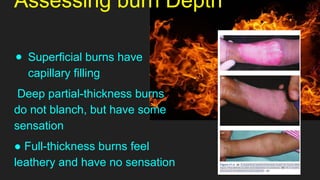 25.Burns..............................pptx