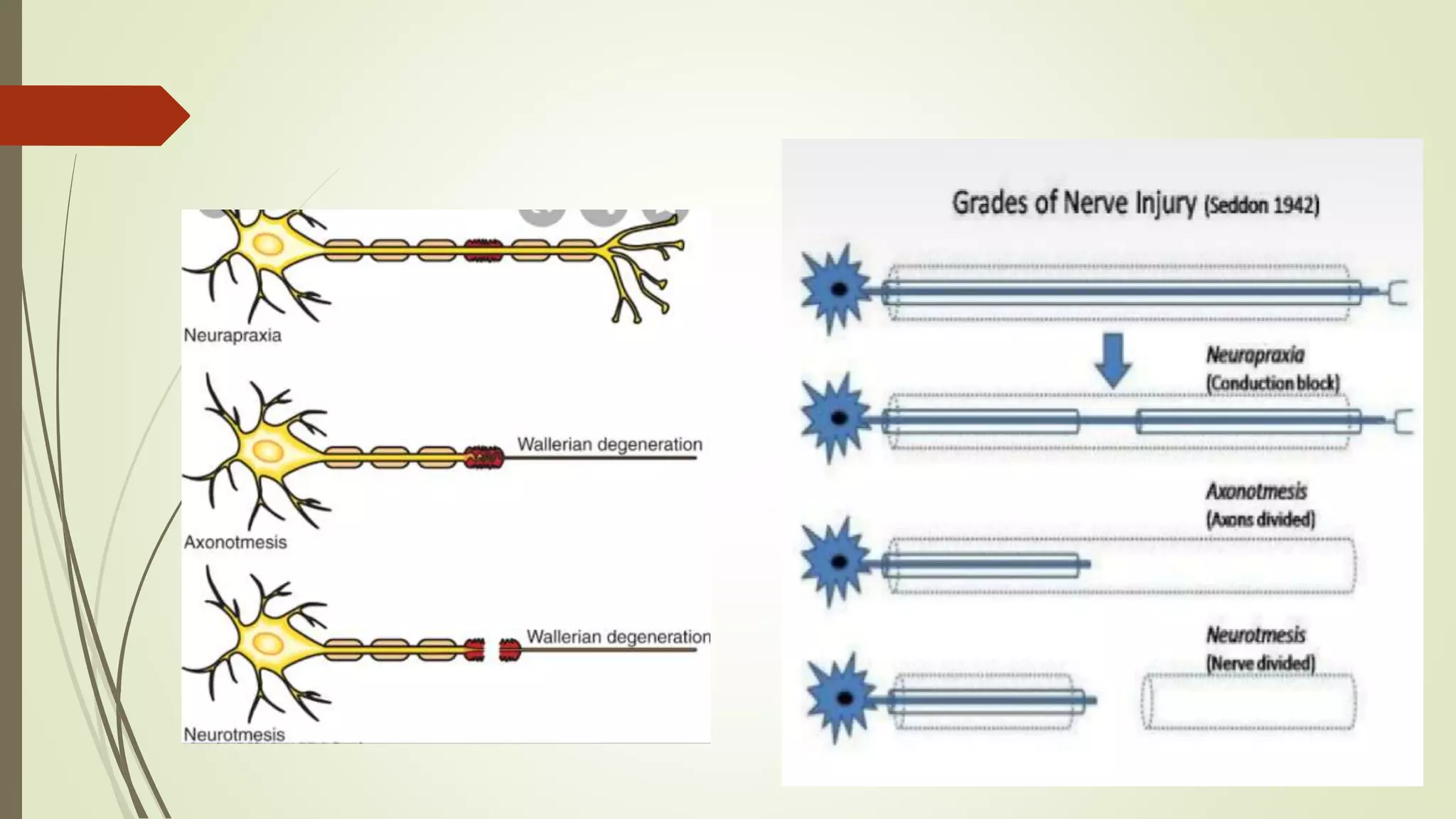 classification and diagnostic methods of peripheral nerve injury | PPTX