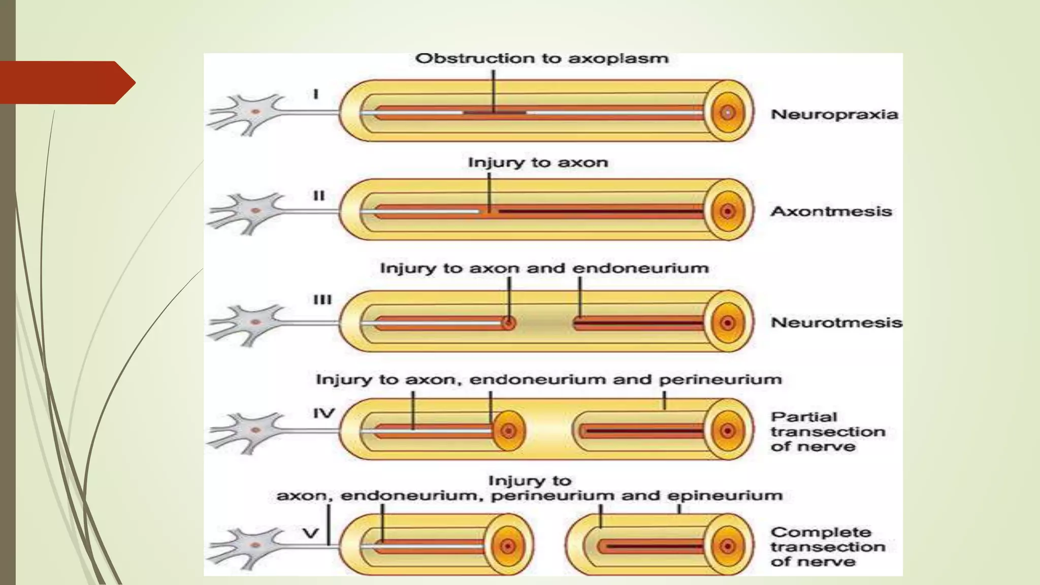 classification and diagnostic methods of peripheral nerve injury | PPTX