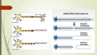 classification and diagnostic methods of peripheral nerve injury | PPTX