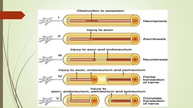 classification and diagnostic methods of peripheral nerve injury | PPTX