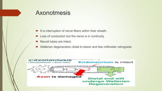 classification and diagnostic methods of peripheral nerve injury | PPTX