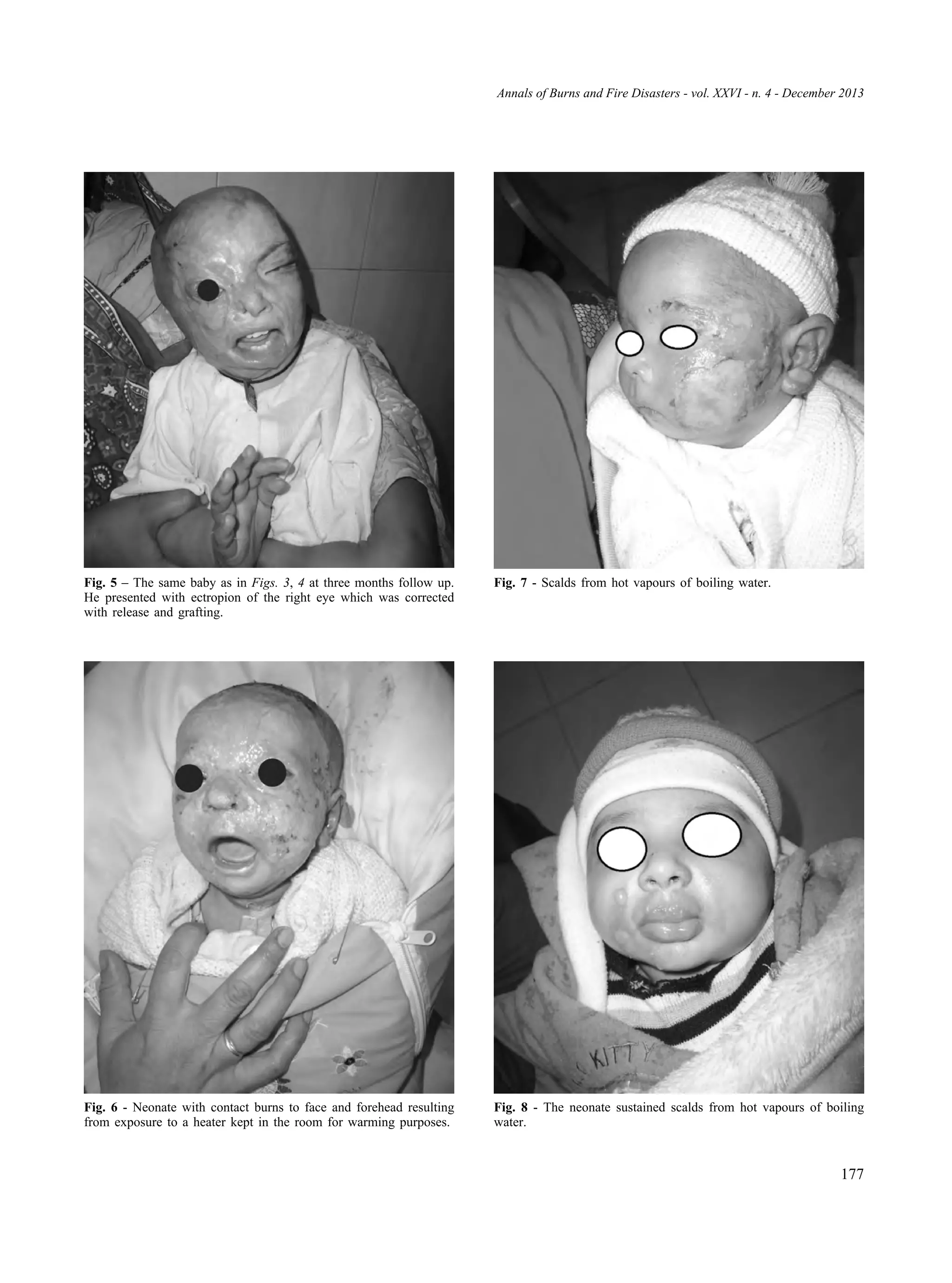 Neonatal Burns | PDF