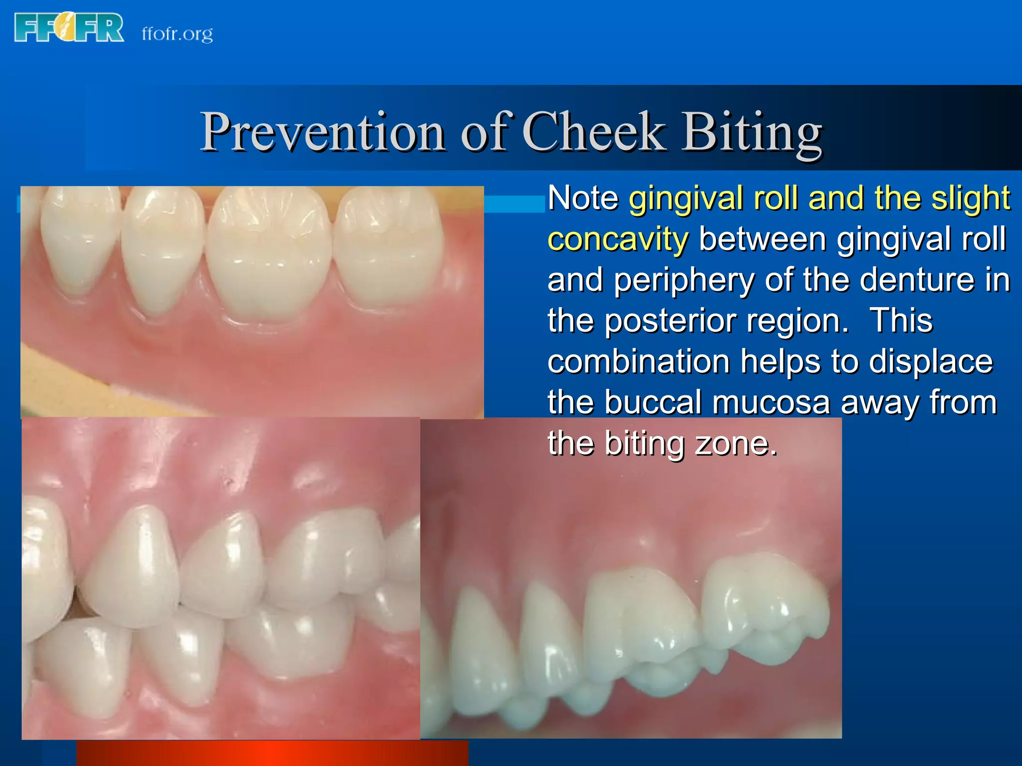 25.final wax contouring | PPT