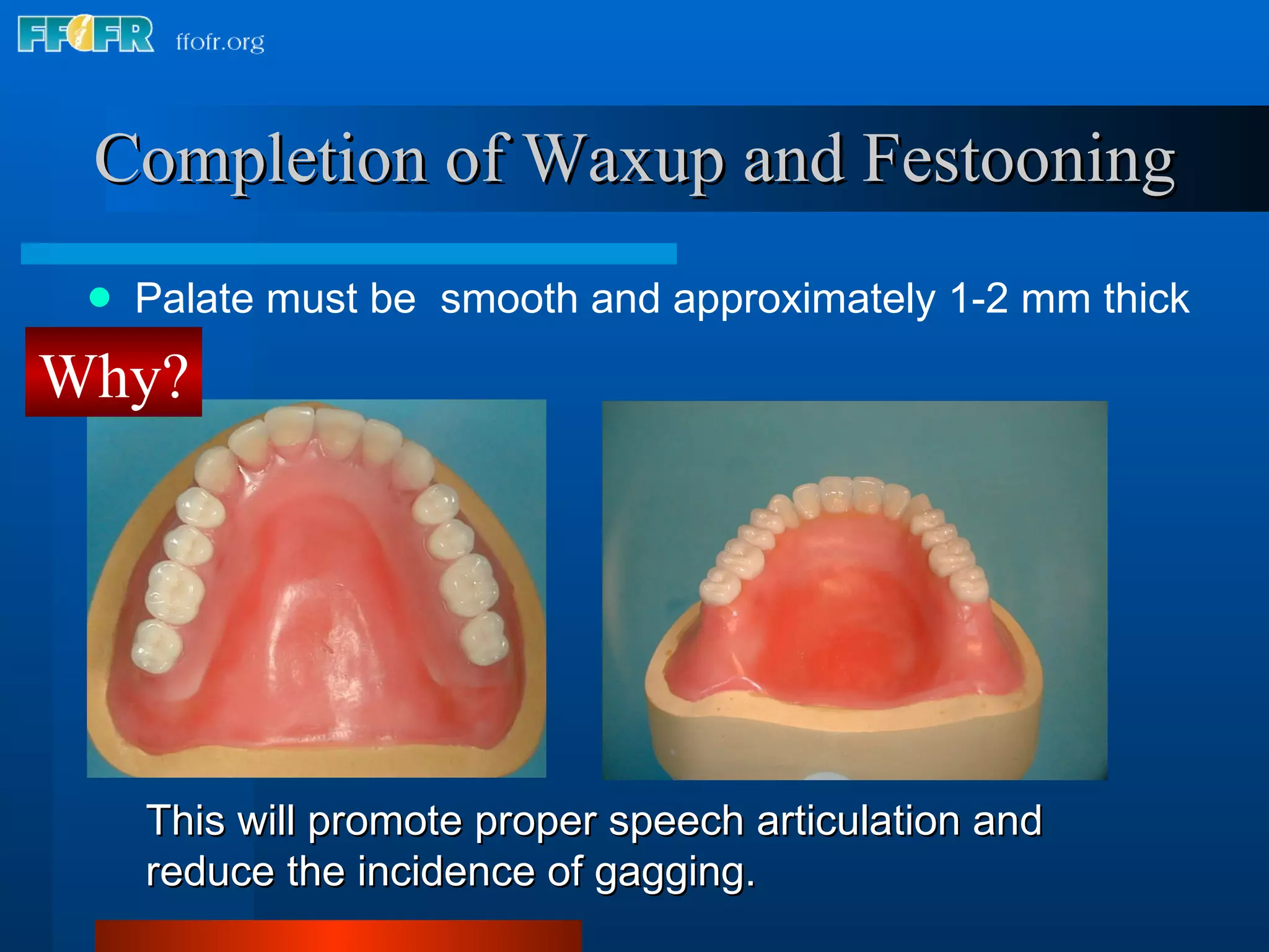 25.final wax contouring | PPT