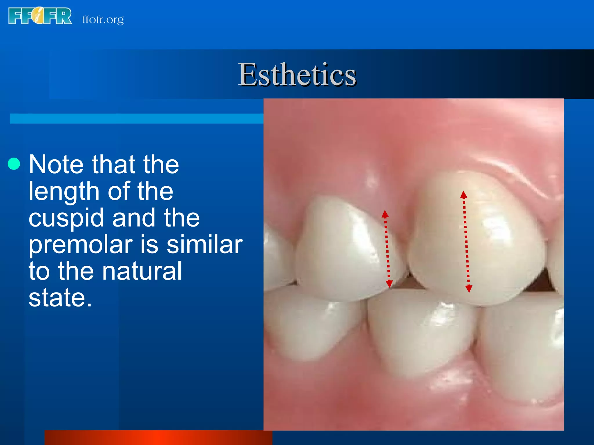 25.final wax contouring | PPT