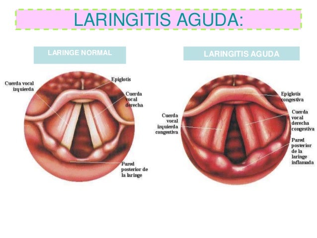 25. laringitis aguda