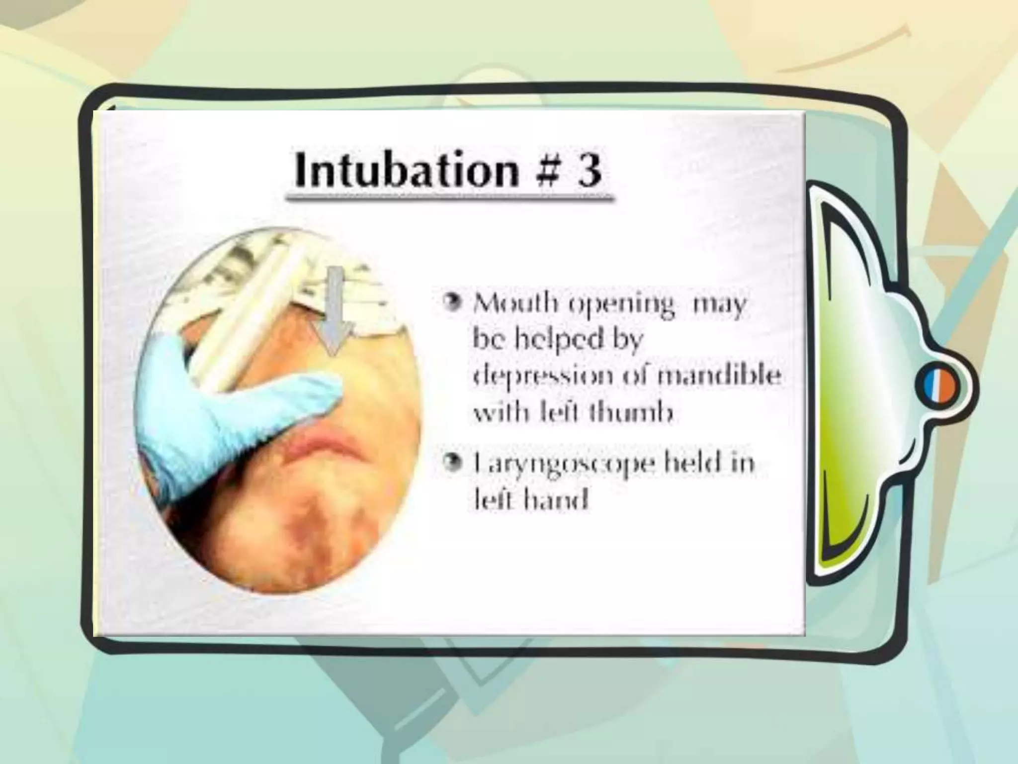 251052812-Endotracheal-Tube-Intubation.pptx