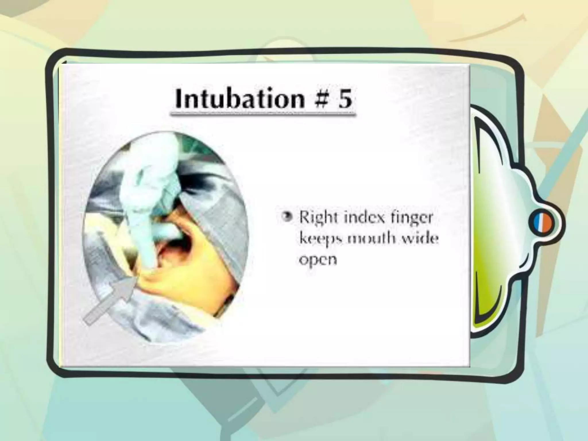 251052812-Endotracheal-Tube-Intubation.pptx