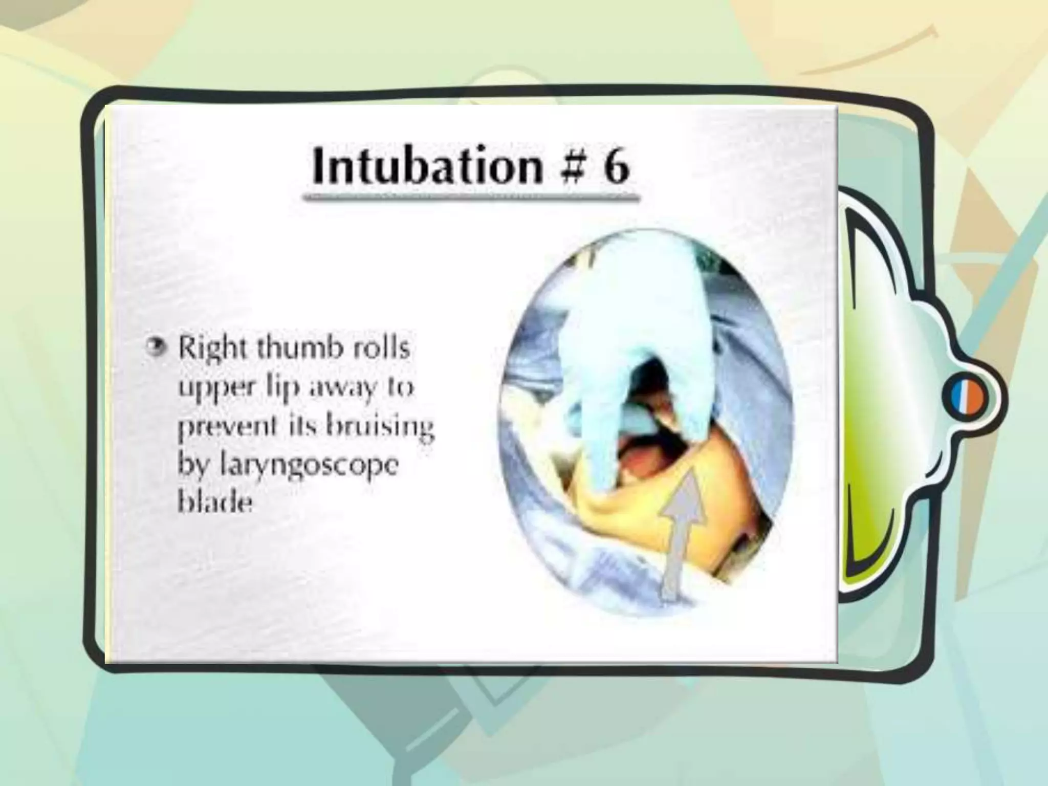 251052812-Endotracheal-Tube-Intubation.pptx