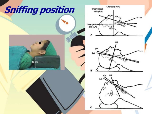 251052812-Endotracheal-Tube-Intubation.pptx