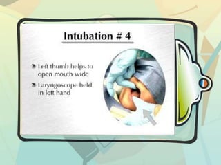 251052812-Endotracheal-Tube-Intubation.pptx