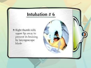 251052812-Endotracheal-Tube-Intubation.pptx