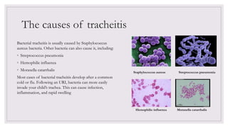 Tracheitis.......ppt