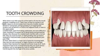 spacing and crowding of teeth | PPTX