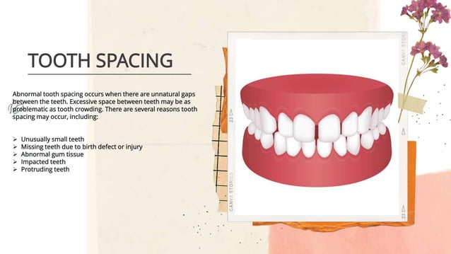 spacing and crowding of teeth | PPTX