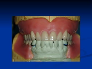 252846671-Wax-Try-In-of-Removable-Partial-Denture-2.ppt