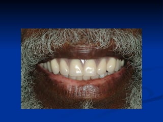 252846671-Wax-Try-In-of-Removable-Partial-Denture-2.ppt