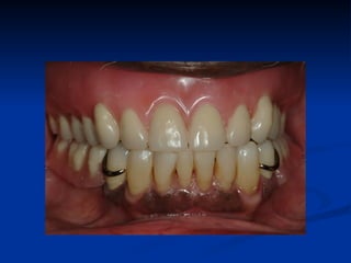252846671-Wax-Try-In-of-Removable-Partial-Denture-2.ppt