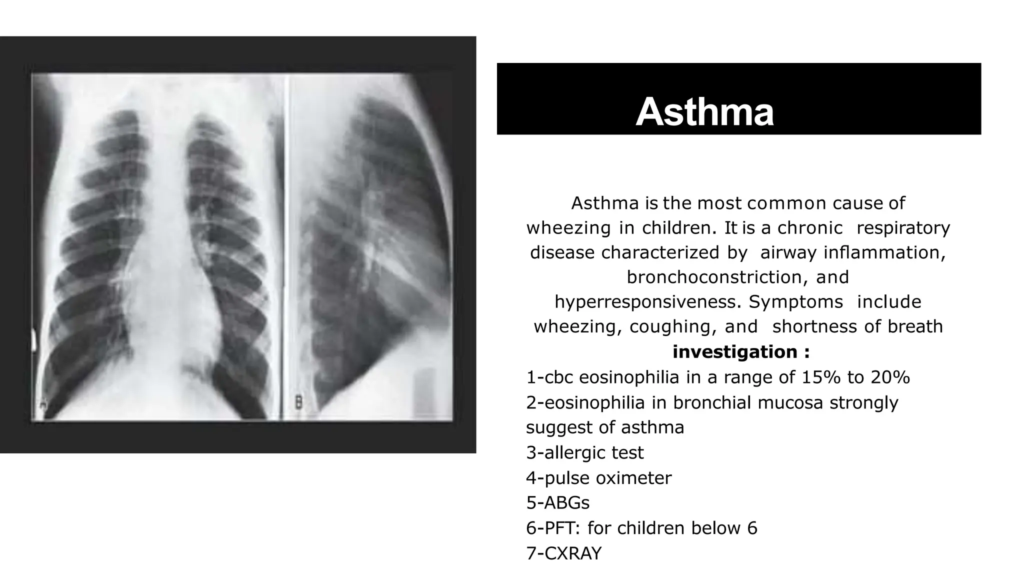 Wheeze chest in Pediatric | PPTX