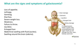Galactosemia | PPTX